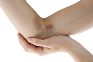 What is IV Drip Therapy?